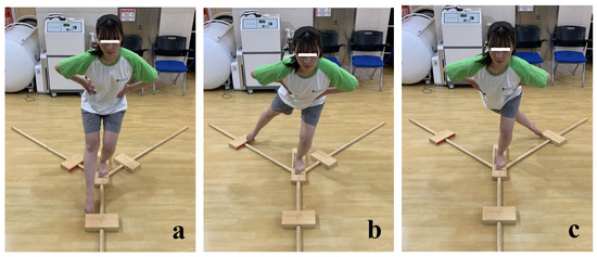 Additional Anterolateral Ligament Reconstruction Helps Patients Improve ...