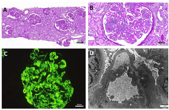 Recurrent C3 Glomerulonephritis along with BK-Virus-Associated Nephropathy after Kidney ...