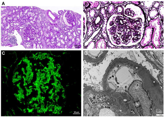Recurrent C3 Glomerulonephritis along with BK-Virus-Associated ...