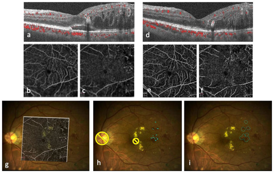 The Role of Laser Photocoagulation in Treating Diabetic Macular Edema ...