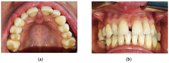 Leiomyoma with Uncommon Localization—Incisive Papilla and Palatal ...