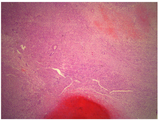 Smooth Muscle Tumor of Uncertain Malignant Potential (STUMP): A ...