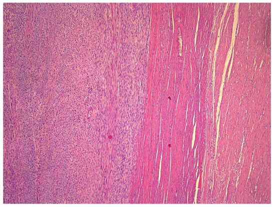 Smooth Muscle Tumor of Uncertain Malignant Potential (STUMP): A ...