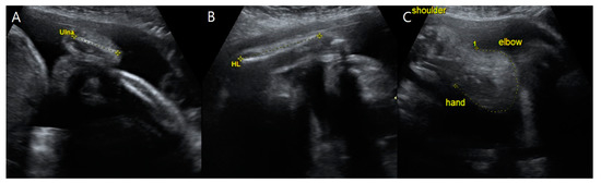Nonfamilial VACTERL-H Syndrome in a Dizygotic Twin: Prenatal Ultrasound ...