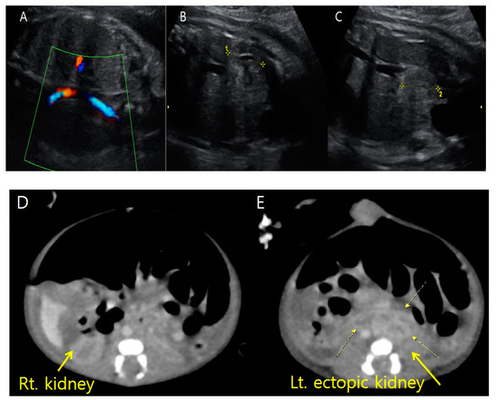 Nonfamilial VACTERL-H Syndrome in a Dizygotic Twin: Prenatal Ultrasound ...