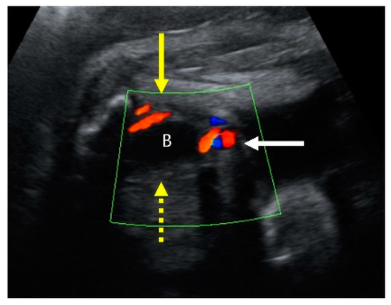 Nonfamilial VACTERL-H Syndrome in a Dizygotic Twin: Prenatal Ultrasound ...