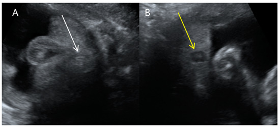 Nonfamilial VACTERL-H Syndrome in a Dizygotic Twin: Prenatal Ultrasound ...
