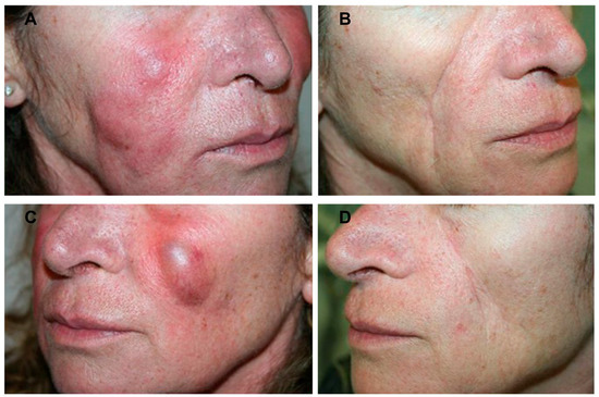 Novel Management of Granuloma Formation Secondary to Dermal Filler with ...