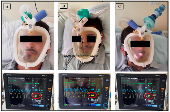 Medicina | Free Full-Text | A New Full-Face Mask for Multifunctional ...