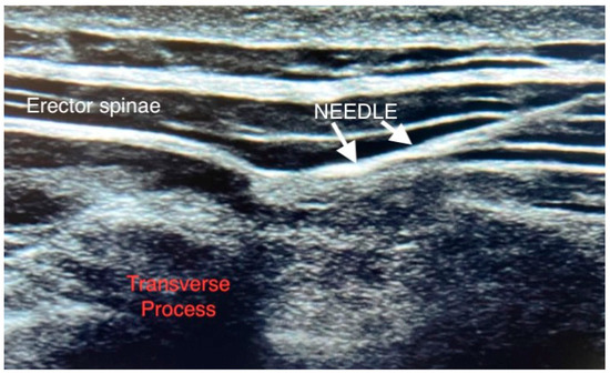 Bilateral Bi-Level Erector Spinae Plane Blocks as a Part of Opioid ...