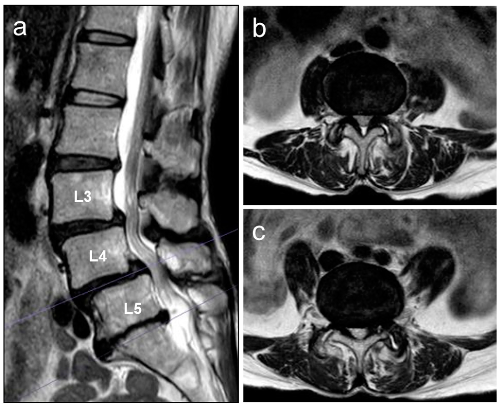 Daily Physical Training Improved Coronal Imbalance of Adult ...