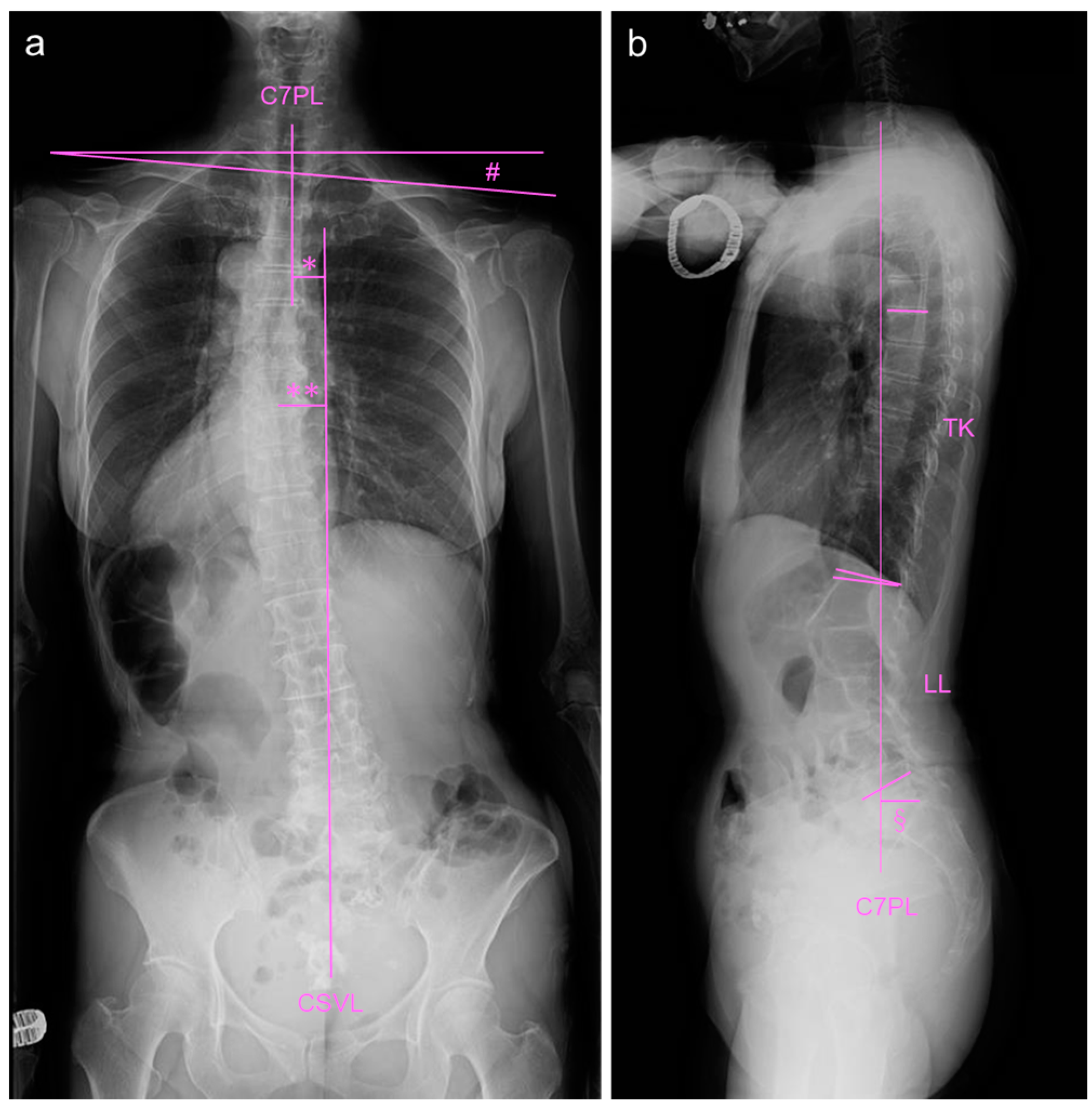 Daily Physical Training Improved Coronal Imbalance of Adult ...