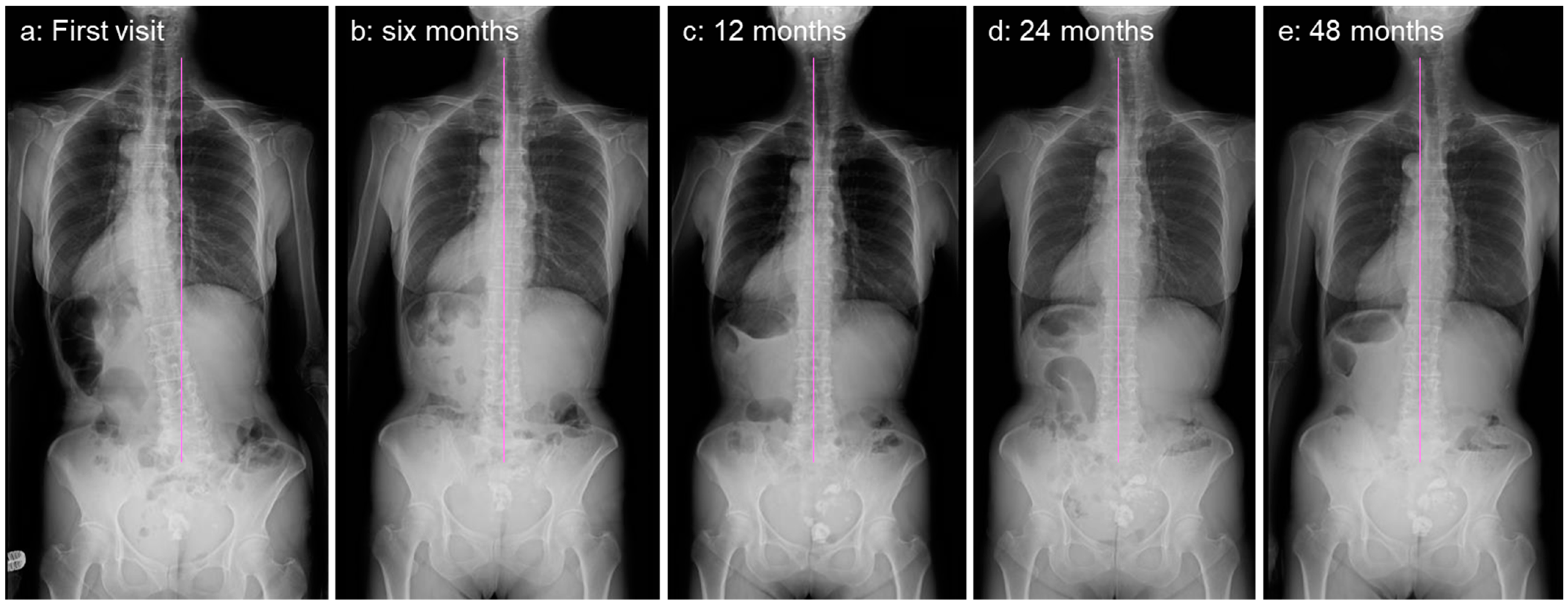 Daily Physical Training Improved Coronal Imbalance of Adult ...