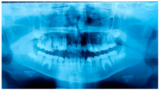 Type I Dentin Dysplasia: The Literature Review and Case Report of a ...