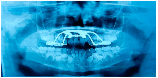 Type I Dentin Dysplasia: The Literature Review and Case Report of a ...