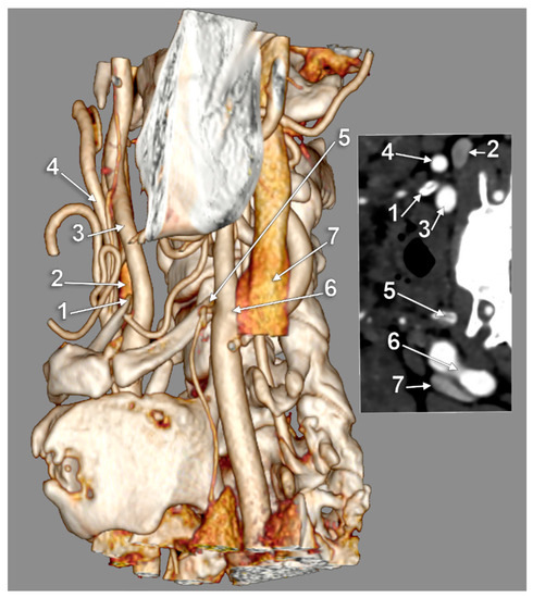 The Carotid–Hyoid Topography Is Variable