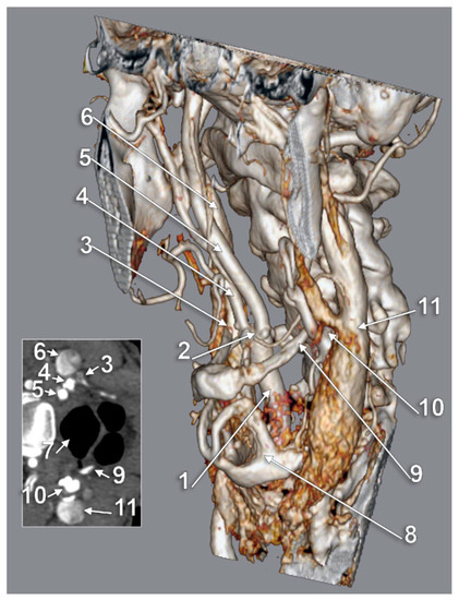 The Carotid–Hyoid Topography Is Variable