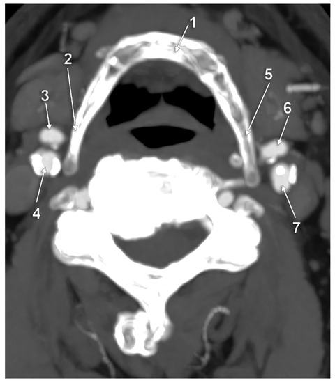 The Carotid–Hyoid Topography Is Variable