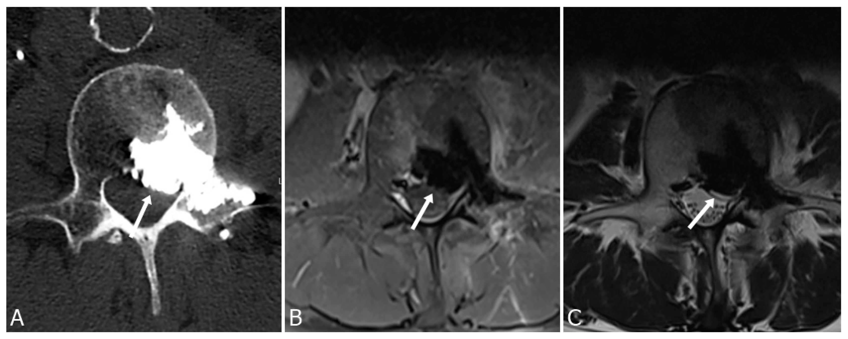 Medicina Free Full Text Complications Of Percutaneous