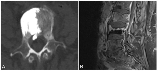 Complications of Percutaneous Vertebroplasty: A Pictorial Review