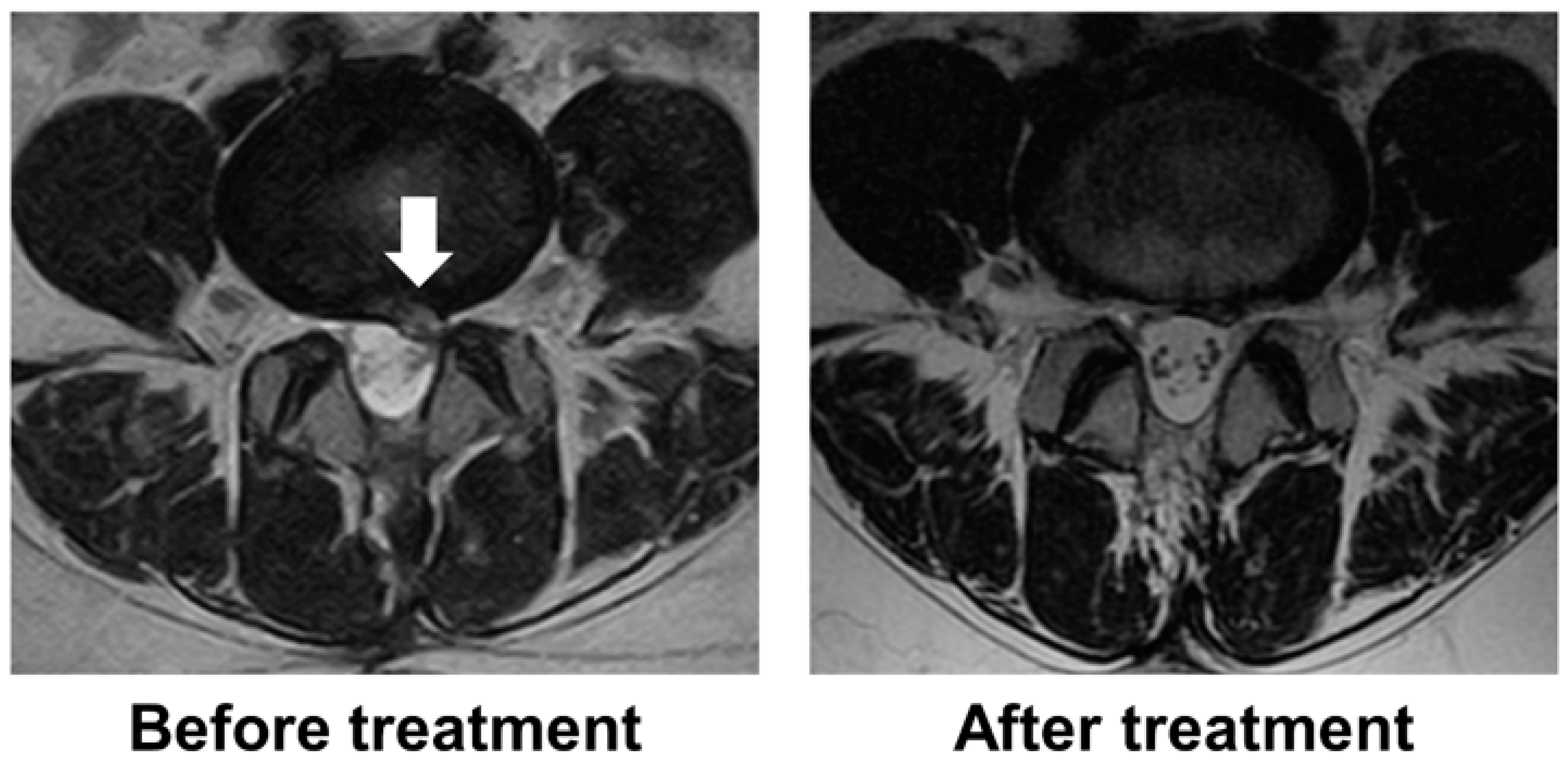 Intradiscal Condoliase Injection Therapy for Recurrent Lumbar Disc ...