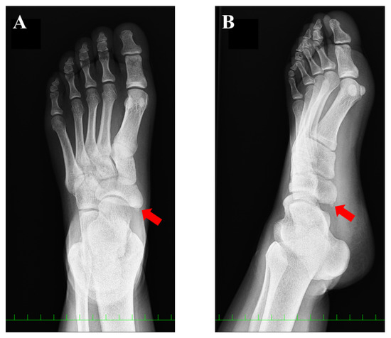 Is the Small Ossicle of Type 1 Accessory Navicular a Cause of Foot Pain ...