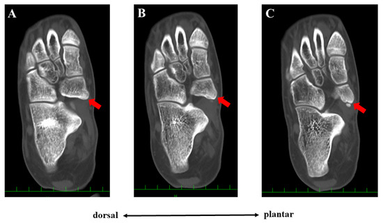 Is the Small Ossicle of Type 1 Accessory Navicular a Cause of Foot Pain ...