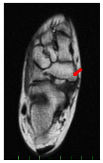 Is the Small Ossicle of Type 1 Accessory Navicular a Cause of Foot Pain ...