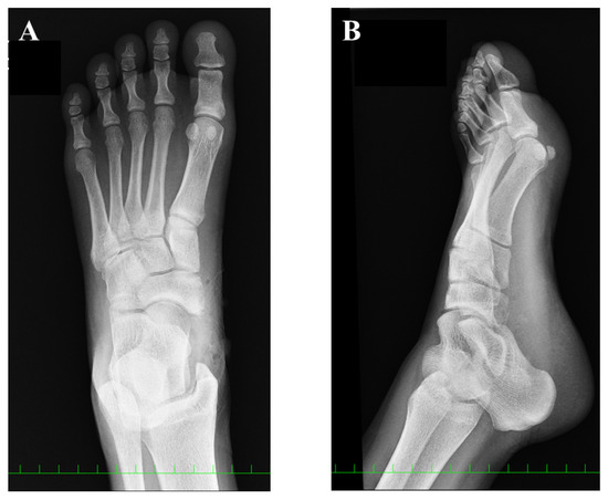 Is the Small Ossicle of Type 1 Accessory Navicular a Cause of Foot Pain ...