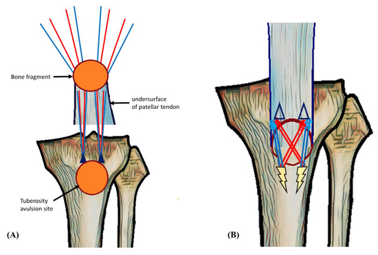 Isolated Avulsion Fracture of the Tibial Tuberosity in an Adult Treated ...