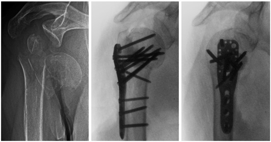 Treatment of Metaphyseal Defects in Plated Proximal Humerus Fractures ...