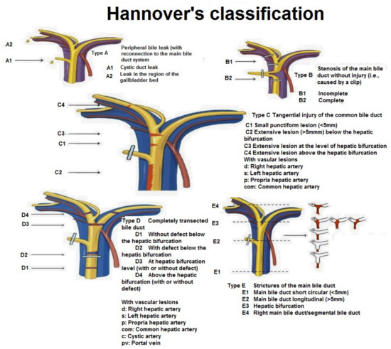 Hepatico-Duodenal Fistula Following Iatrogenic Strasberg Type E4 Bile ...