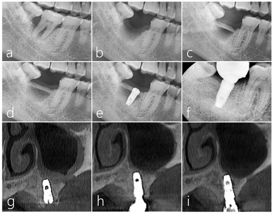 Medicina | Free Full-Text | The Bone Bridge Technique Utilizing Bone ...