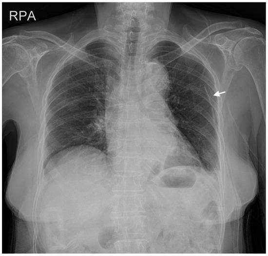 Unexpected Tension Pneumothorax Developed during Anesthetic Induction ...