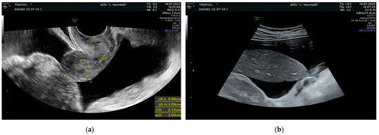 Meigs Syndrome and Elevated CA-125: Case Report and Literature Review ...