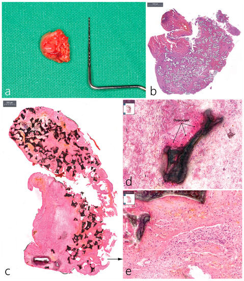 Medicina | Free Full-Text | Lateral Peri-Implantitis: Successful ...