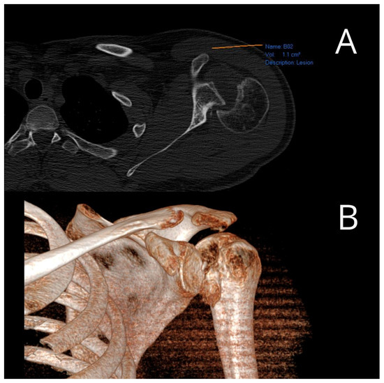 Segmental Humeral Head Reconstruction in Patients with Chronic Locked ...
