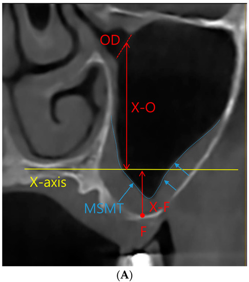 Change in Maxillary Sinus Mucosal Thickness in Patients with ...