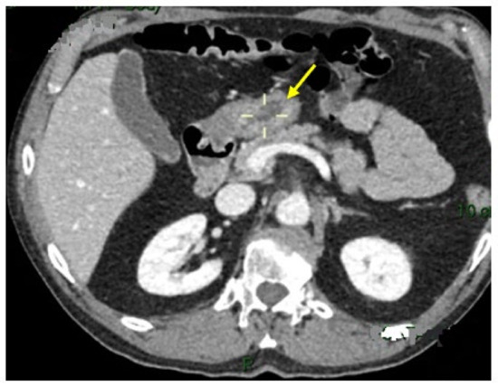 Gastritis Cystica Profunda: A Rare Disease, a Challenging Diagnosis ...
