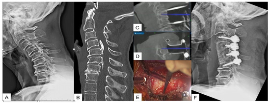 A C-Arm-Free Minimally Invasive Technique for Spinal Surgery: Cervical ...
