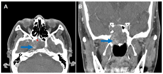 Successful Endoscopic Transsphenoidal Approach Treatment of Sphenoid ...