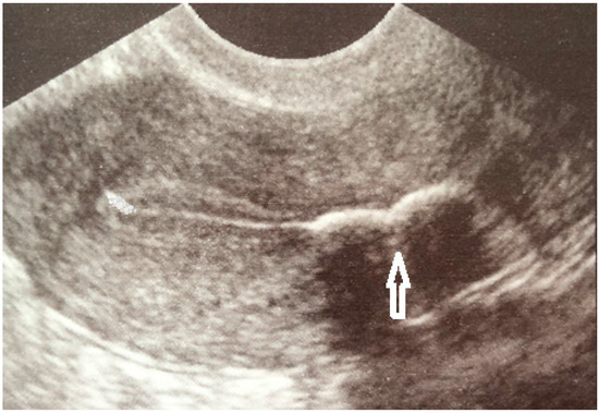 Endometrial Osseous Metaplasia—A Rare Cause of Infertility with Unknown ...