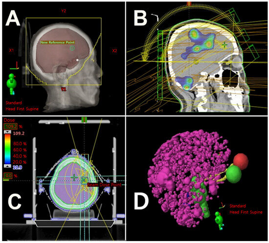 Selecting the Appropriate Radiation Therapy Technique for Extensive Brain Metastases from Tens ...
