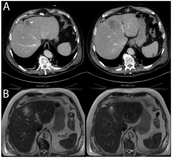 Bacterial Infection of an Alveolar Echinococcus Cyst from C ...