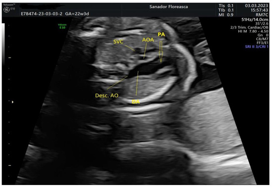 Perinatal Diagnosis and Management of a Case with Interrupted Aortic ...