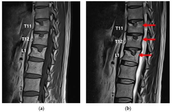 Percutaneous Vertebroplasty in a Patient with Chronic Back Pain Caused ...