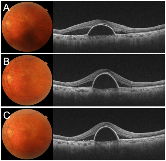 Medicina | Free Full-Text | Intraocular Inflammation Secondary to ...