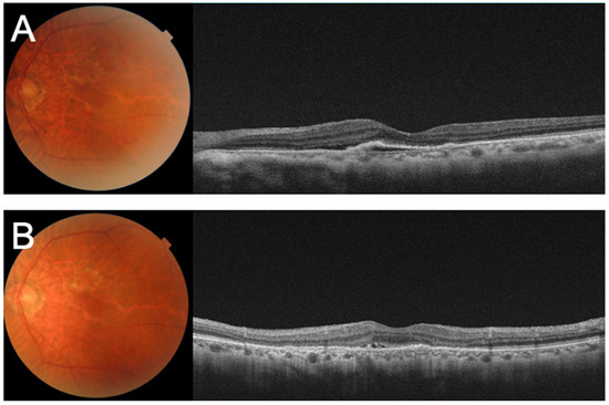 Medicina | Free Full-Text | Intraocular Inflammation Secondary to ...