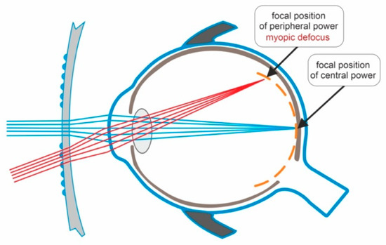 Preventing the Progression of Myopia in Children—A Review of the Past ...