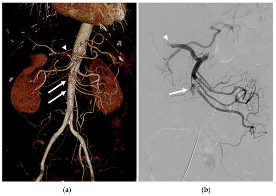 Microcatheter-Directed Thrombolysis Using Recombinant Tissue ...